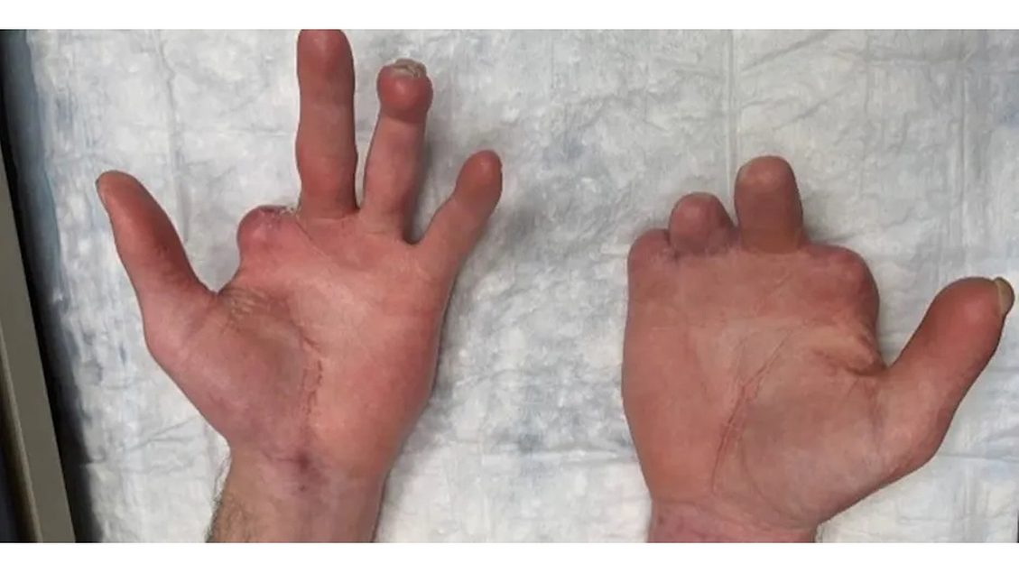 HVAC Tech Loses Most of Hands in Explosion, Awarded $75 Million | ACHR News